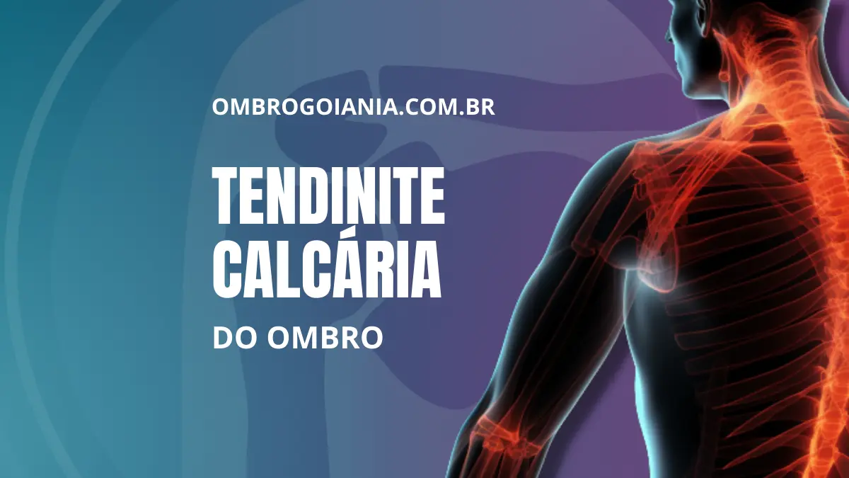 Tendinite Calcária do Ombro - Blog Ombro Goiânia