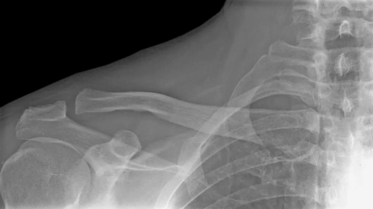 Cirurgia de clavícula com placa: indicações e recuperação - Blog Ombro ...