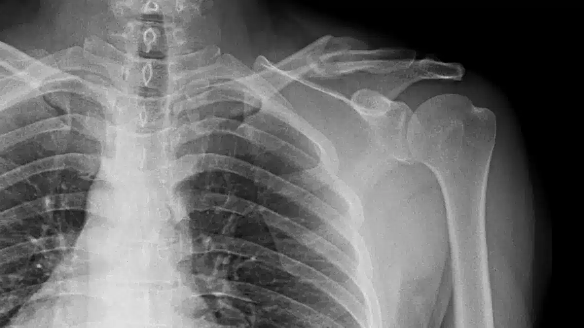 Clavícula quebrada precisa de cirurgia? Saiba quando - Blog Ombro Goiânia